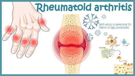 Rheumatoid Arthritis 5 Natural Ways To Manage The Symptoms Vitality