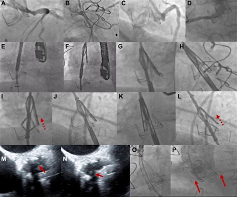 技术前沿 修建成：tavr术中预防冠脉阻塞的瓣叶分离器械（shortcut™） Fim研究结果公布 严道医声网