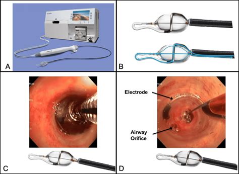Image Of The Nuvaira Console With The Dnerva Catheter In Bronchoscope