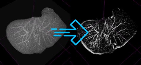 3d Slicers Liver Segmentation A Look At The New Features