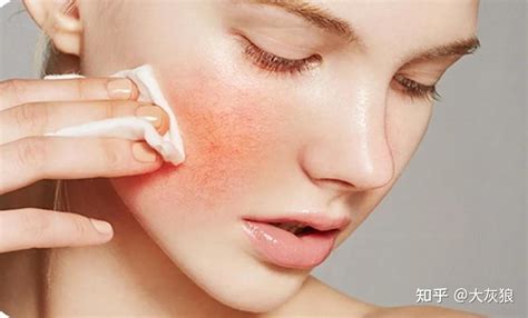 导致皮肤发炎的主要原因有哪些？ 知乎