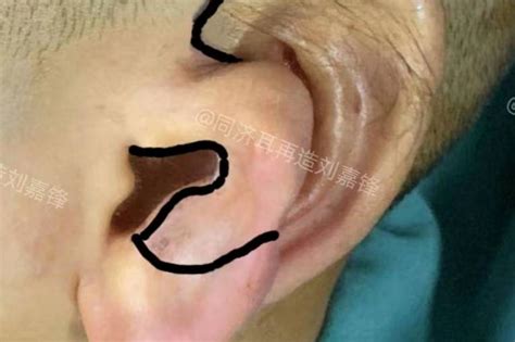 孩子因耳畸形被嘲笑父母后悔多年 胡女士 手术 丈夫 孩子因耳畸形被嘲笑父母后悔多年 胡女士 手术 丈夫