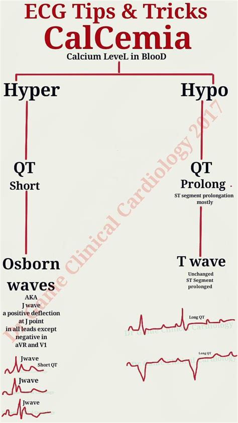 Hypocalcemia Ekg