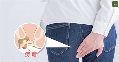 血便是痔瘡、肛門瘻管，還是大腸癌？症狀分辨、治療、手術方式一次看！