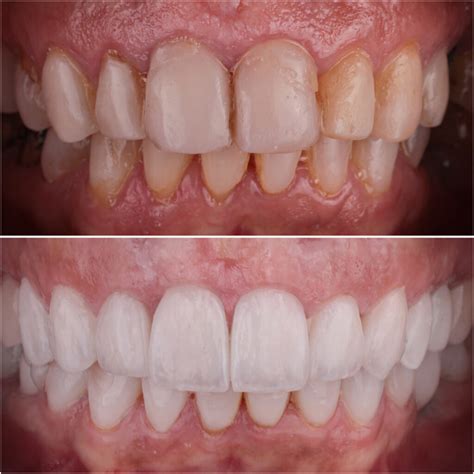 Smile Gallery Leeds Dental Implant And Cosmetic Clinic By Hassan