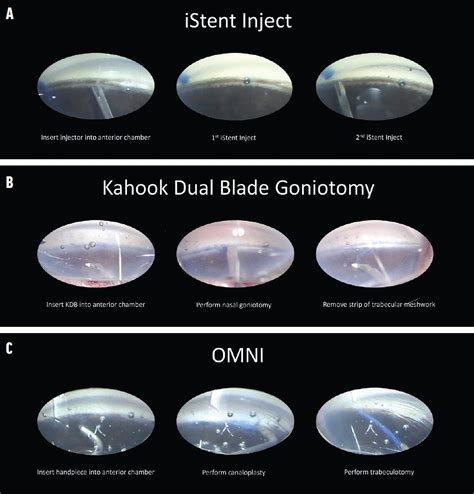 Cataract And Refractive Surgery Today On Linkedin Combined Management Of