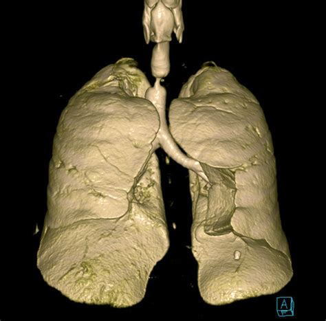 3d Reconstruction Of Ct Chest Showing The Level And Extent Of The