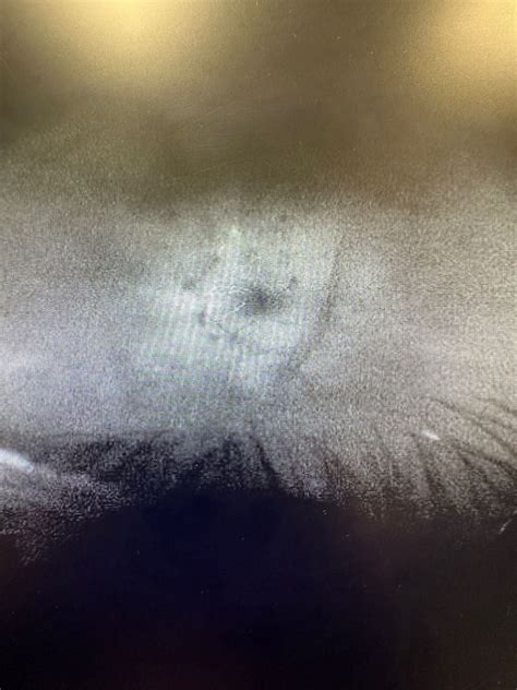 Amazing Xipere Occlusiveretinalvasculitis Charles Mayron Md Facs