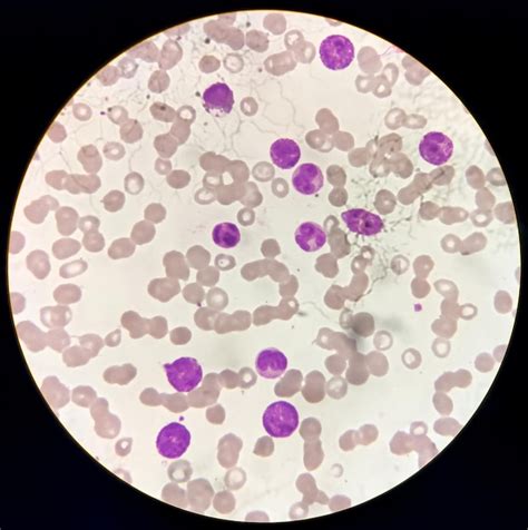 Premium Photo Chronic Myeloid Leukemia Cells Or Cml Analyze By