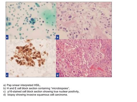 Cell Block In Cytology Ppt