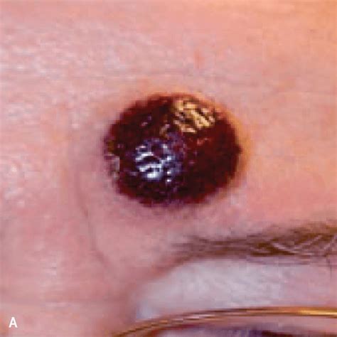 Bpdcn Dermatologic Presentation Elzonris® Tagraxofusp Erzs