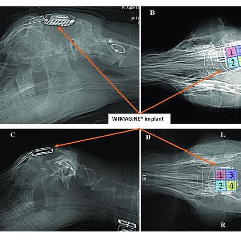 A Picture Of A Clinical Electrocorticography ECoG Grid Underneath A Download Scientific