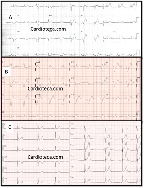 ¿sabes Qué Patologías Pueden Producir Onda T Alta Y Picuda