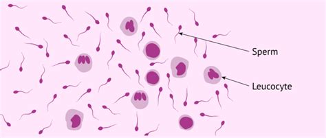 Leukocytospermia Or Pyospermia Causes And Treatment