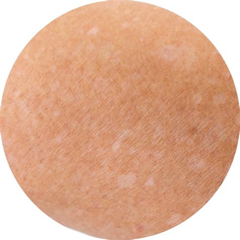 White Spots Causes And Treatment