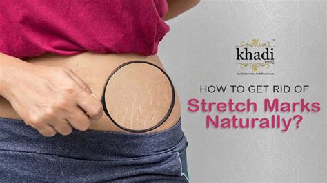 How To Get Rid Of Stretch Marks Naturally