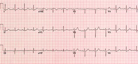 Truth Of The Talisman Ekg Flashcards Quizlet
