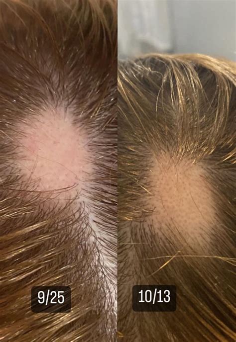 L Exclamation Point” Hairs Vs R Regrowth Follicles Does This
