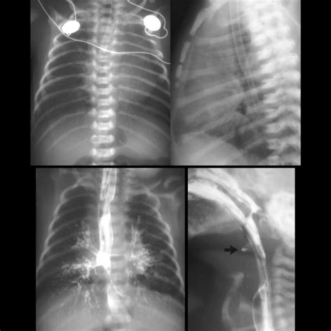 Tracheal Atresia Pediatric Radiology Reference Article Pediatric