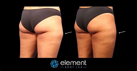 Cellulite Inner Thighs