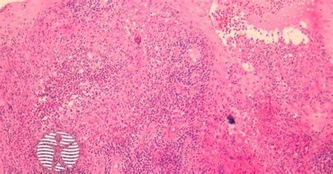 Sporotrichosis Pathology Image