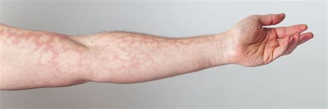 Patterns Of Reticulated Livedoid Skin Following Vascular Complications