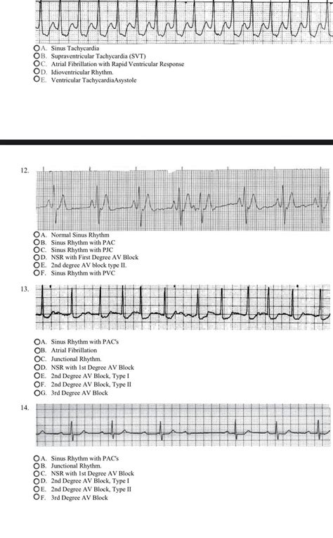 Junctional Tachycardia Vs Svt