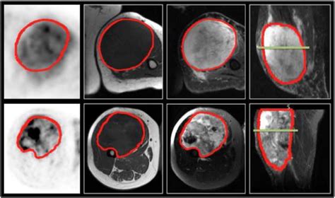 Radiomics Based Metastases Prediction Model Wins Journal Prize Physics World