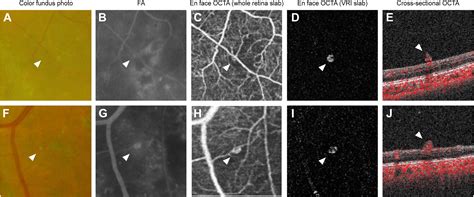 Practical Utility Of Widefield Oct Angiography To Detect Retinal Neovascularization In Eyes With