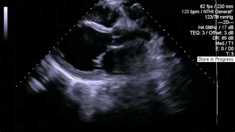Severely Dilated Lv Hypokinesis Along The Septal Inferior Lateral