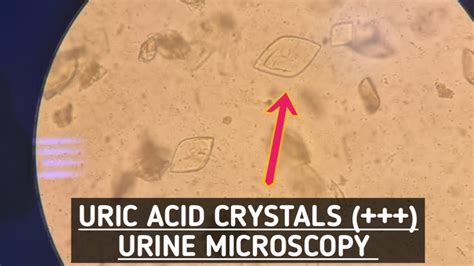 Uric Acid In Urine