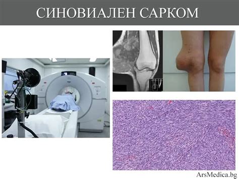 Варицела симптоми усложнения Arsmedica Bg