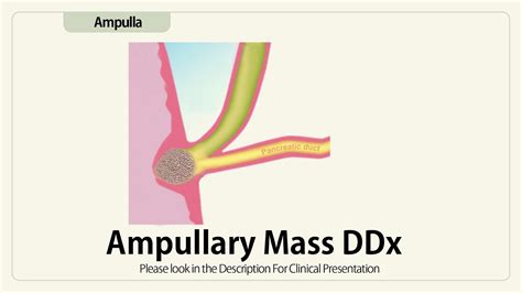Ampullary Mass Ddx Youtube