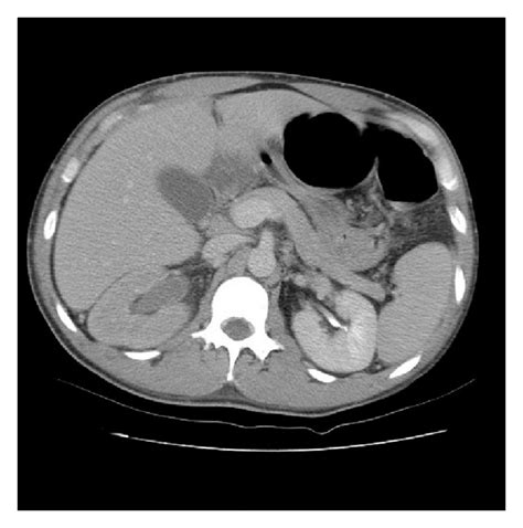 Computerized Tomography Ct Of Abdomen Revealed A Mild Right