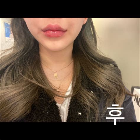 입술필러 너무만족해용 0 리얼후기 부산 밸런스 성형외과