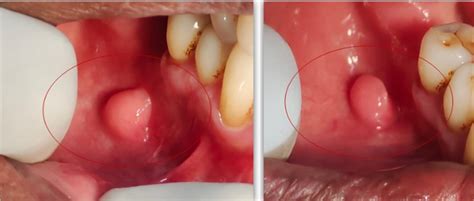 Intraoral Examination Showing Dome Shaped Swelling In Right Mandibular Download Scientific