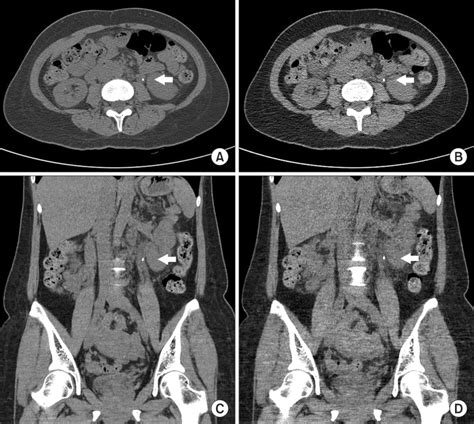 comparison of conventional nonenhanced computed tomography with