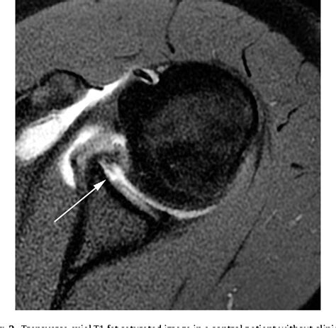 Figure 3 From Frequency Of Glenoid Chondral Lesions On Mr Arthrography