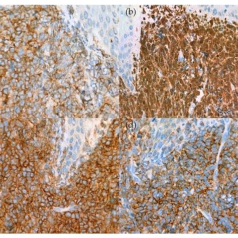 Immunohistochemical Stain A Positivity Of Cd79a 400× Original