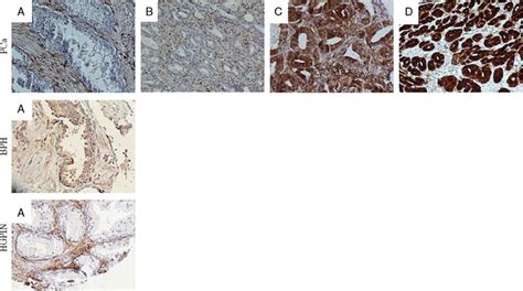 Immunohistochemical Analysis Of Aldehyde Dehydrogenase 1 A1 Aldh1a1