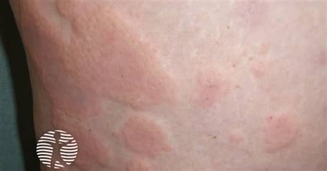 Urticaria Image