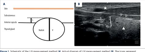 Figure 1 From Extra Thyroid Extension Prediction By Ultrasound Quantitative Method Based On