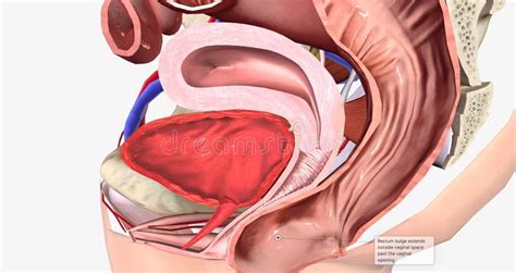 Rectum Bulge Extends Outside Vaginal Space Past The Vaginal Opening