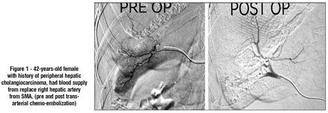 Determining Risk Factors For Post Embolization Syndrome In Patients