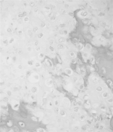 Histological Evidence Of Recurrent Periosteal Osteosarcoma Cells