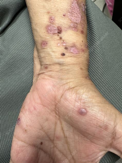 Bullous Pemphigoid Stock Image C0607384 Science Photo Library