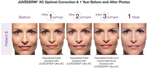 JuvÉderm® Azura Skin Care Center