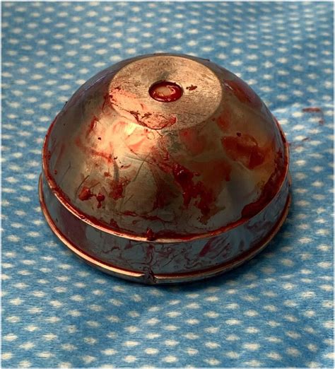 The Titanium Acetabular Shell Without Evidence Of Back Side Wear