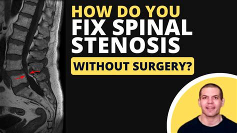 Spinal Stenosis And Balance Problems 3 Ways To Improve Balance
