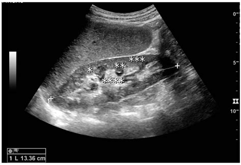 Renal Pyramids Ultrasound